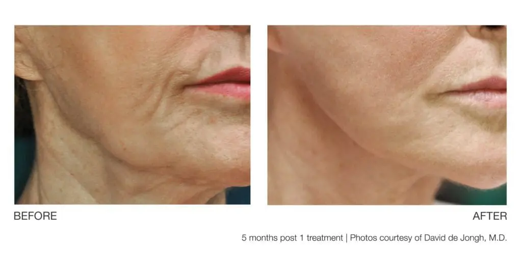 Profound RF Nonsurgical Facelift Twin Cities Minnesota