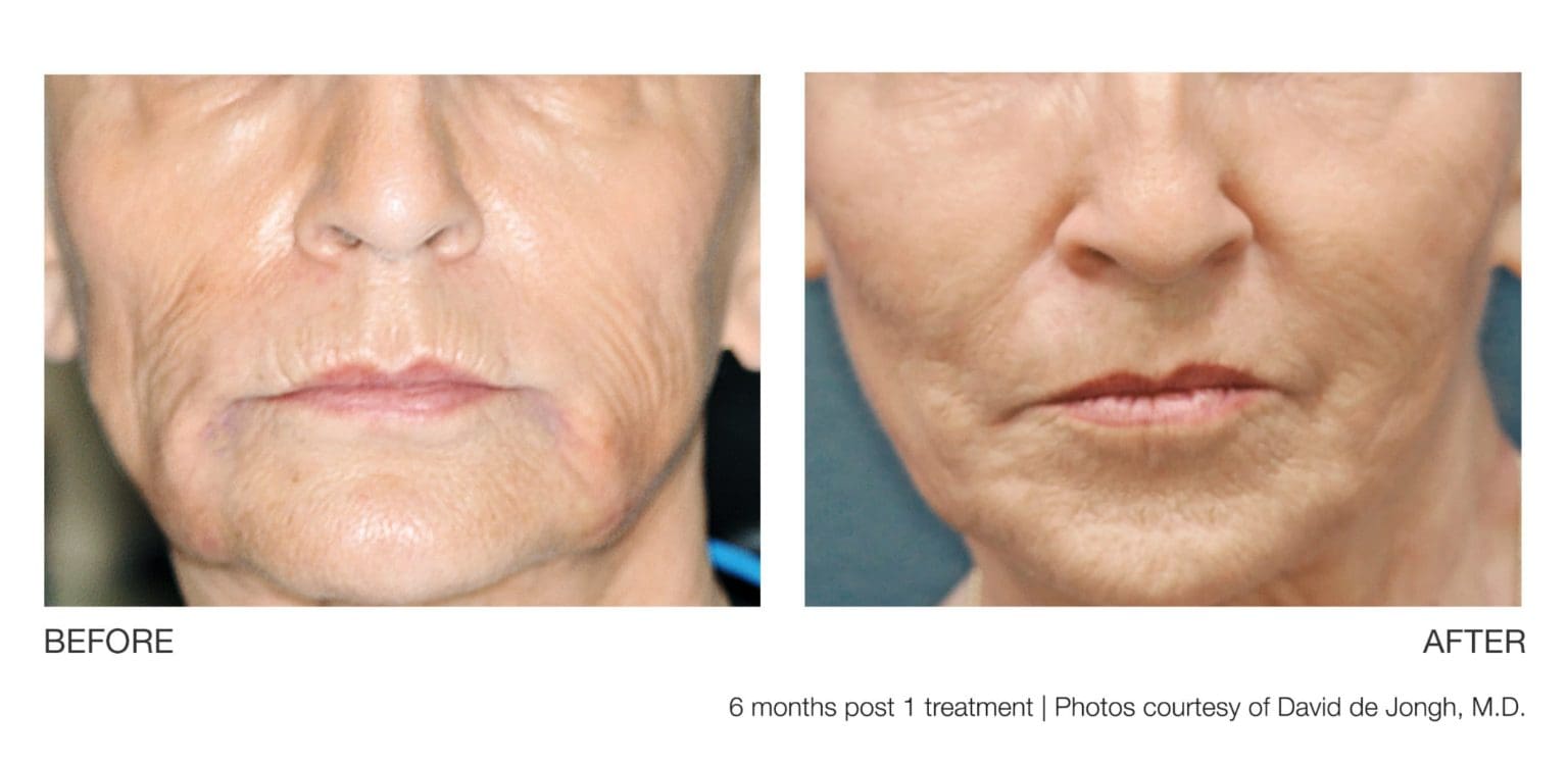 Profound RF Nonsurgical Facelift Twin Cities Minnesota